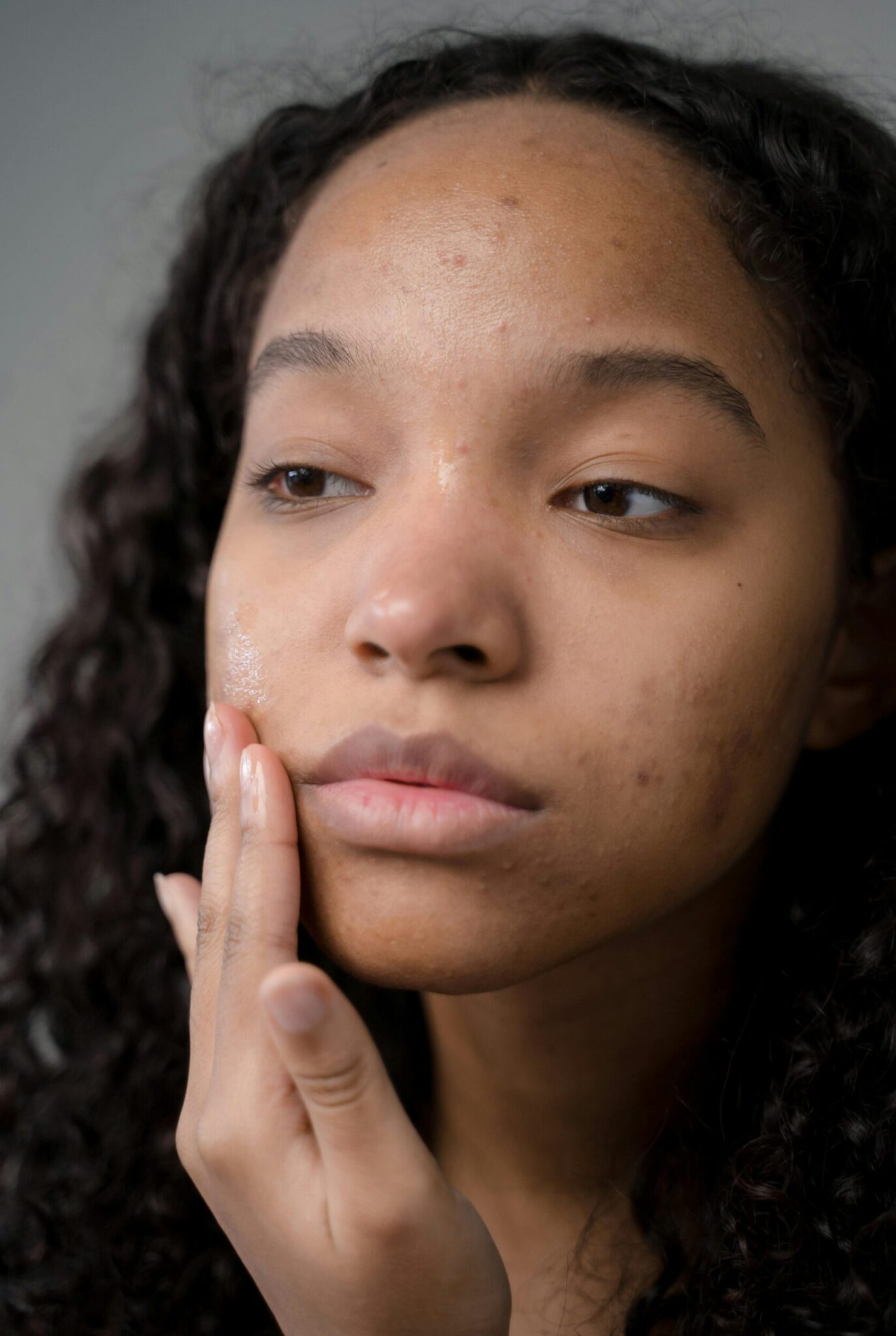 Did You Know Too Much Sugar Can Cause Acne? | BN Style